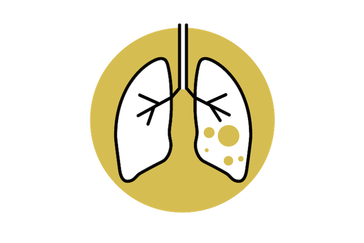 Lung Cancer Screening (CT) » Naperville Radiologists